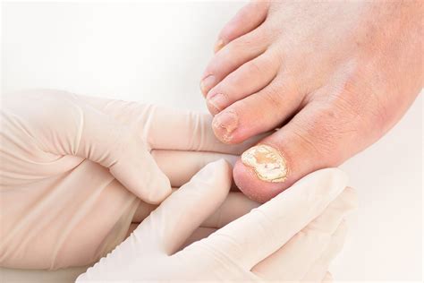 Lunula Cold Laser Fungal Nail Treatment My Footdr