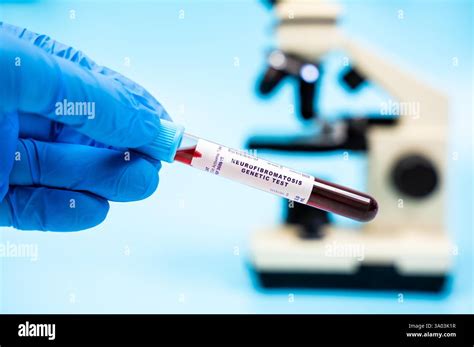 Detects Mutations In Nf1 Or Nf2 Genes Which Can Lead To