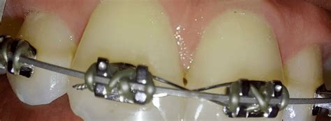 My Dentist Said They Dont Fix Deep Bites With Bite Plates Or Bite