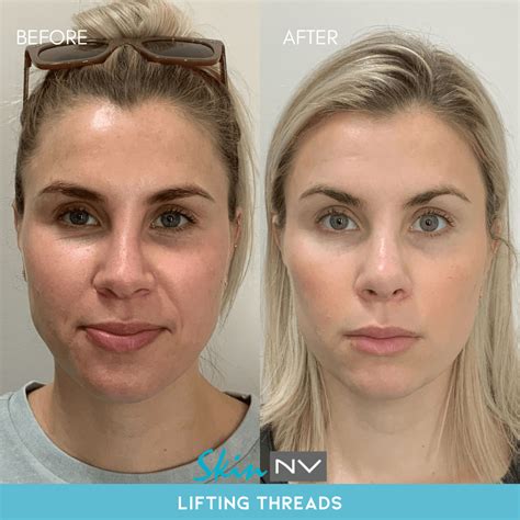 threading before and after