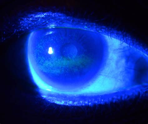 How Systemic Drugs Trigger Dry Eye Disease