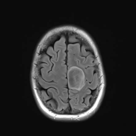T FLAIR Mismatch Sign Radiology Reference Article Radiopaedia Org