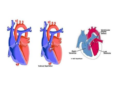 Ppt Ventricular Septal Defect Vsd Powerpoint Presentation Id6330625