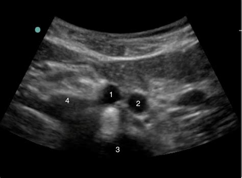 Aortic Bifurcation Ultrasound