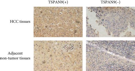 The Correlation Between The Expression Of Tspan9 And Hcc Prognosis A