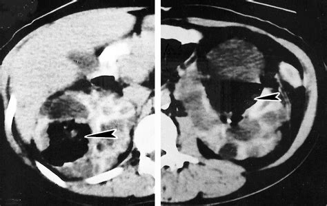 Emphysematous Pyelonephritis Clinicoradiological Classification