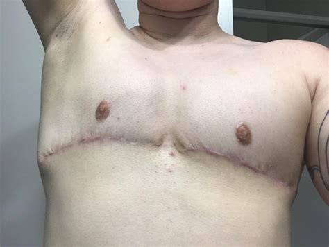 6 Months Post Op And I Couldnt Be Happier Rtopsurgery