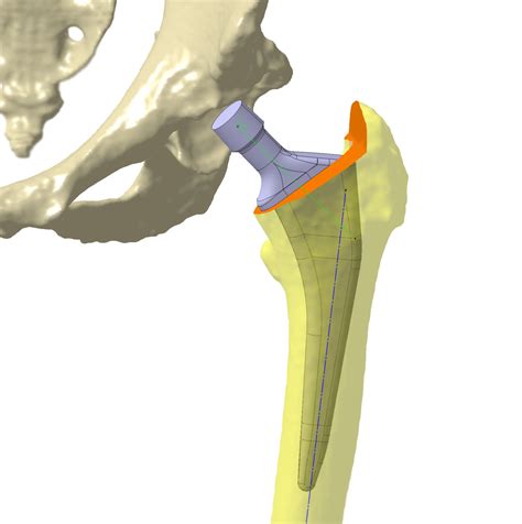 Stl File Tibia Implant Real Layout For Training・model To Download And