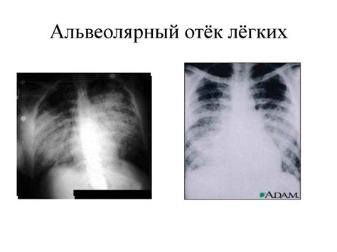 Тотальное и субтотальное затемнение легких презентация онлайн