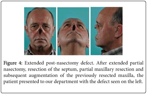 Total Nasal Reconstruction After Nasectomy In A Case Of Massive