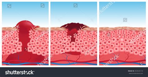 Scabs Stock Illustrations Images Vectors Shutterstock