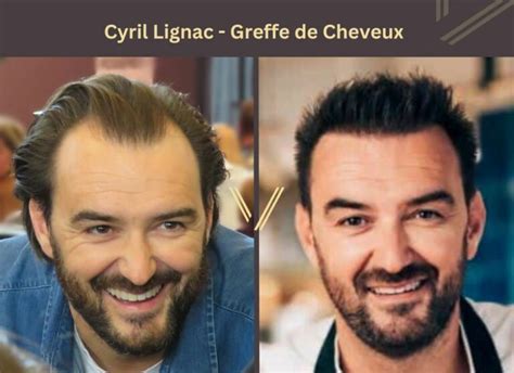 Greffe de Cheveux Chez les Stars 35 Photos Avant et Après