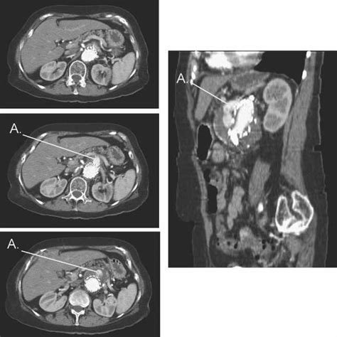 Axial And Sagital Ct Images Confirm Presence Of Large Type I Endoleak