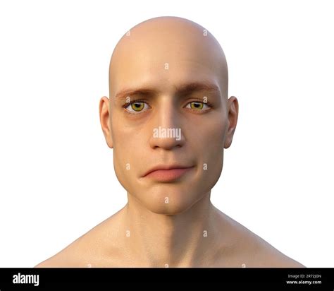 Bells Palsy A Unilateral Facial Paralysis Computer Illustration The