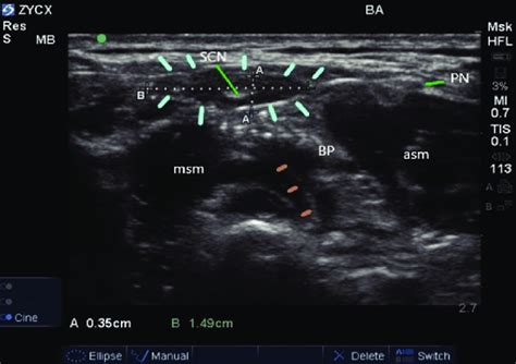 Supraclavicular Nerve Block The Needle Is Positioned Between The Scm
