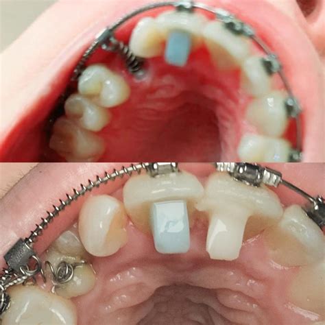 30f Impact Tooth 21 Day Update Rbraces
