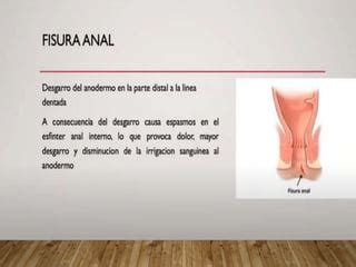 Fisura Y Fistula Anal Diagnostico Tratamientopptx
