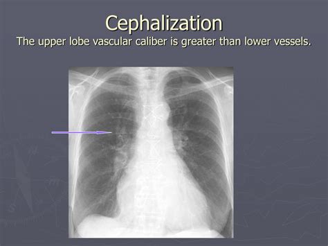 Cephalization Definition Chest X Ray At Frank Jobe Blog