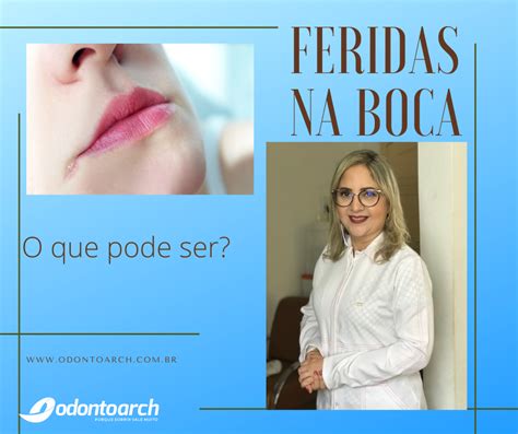 Feridas Na Boca O Que Pode Vir A Ser Odontoarch