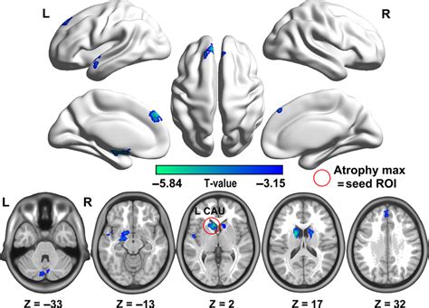 Overall Gray Matter Atrophy Pattern In Patients With Pd Compared With Download Scientific