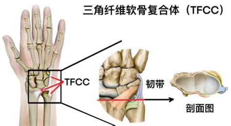 健身引起的三角纤维软骨复合体tfcc损伤预防和康复 知乎