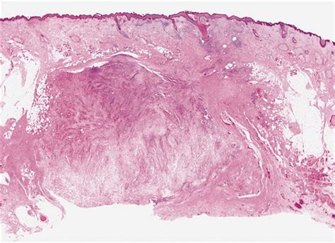 Pathology Outlines Nodular Fasciitis
