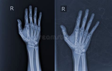 X Ray Hand Showing 2th Metacarpal Fracturemedical Image Concept Stock Image Image Of Doctor X Ray Hand Showing 2th Metacarpal Fracturemedical Image Concept Stock Image Image Of Doctor