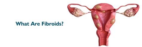 Uterine Fibroids Types