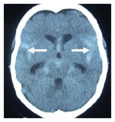 Second Ct Scan Brain Without Contrast Showing Clearly Visible Download Scientific Diagram