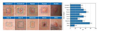Towards Accurate Acne Detection Via Decoupled Sequential Detection Head