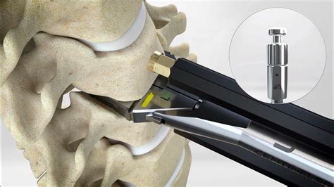 Prodisc C Vivo Surgical Technique W Prodisc Cervical V2 Instrument Set