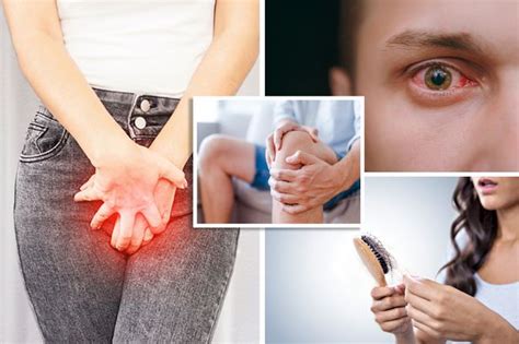 Dangers Of Super Gonorrhoea From Infertility To Blindness As Global