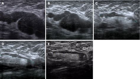 ultrasound of the targeted lymph node a before the second cycle of