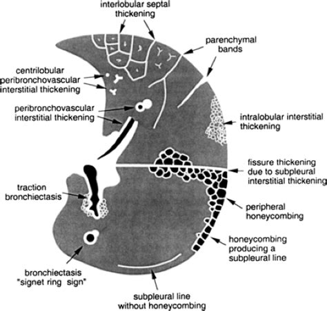 Diffuse Lung Disease Thoracic Key