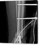 Tibial Fracture Photograph By Rajaaisya Science Photo Library Fine