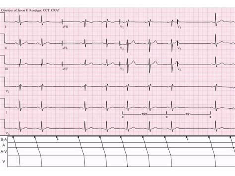 Ecg Lecture Sinus Arrest Sinoatrial Exit Block Av Block And Escape