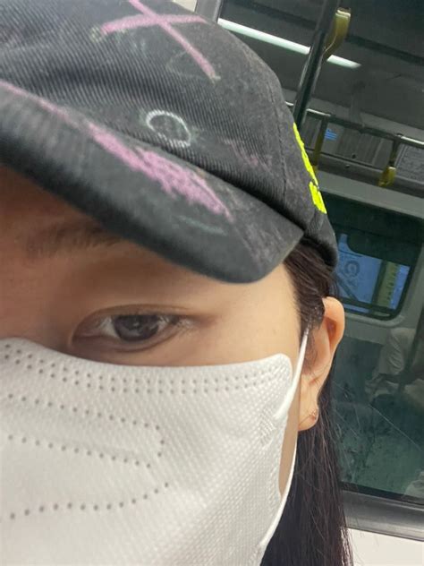 역삼역피부과 추천 편평사마귀 비립종 얼굴 제거 후기 네이버 블로그