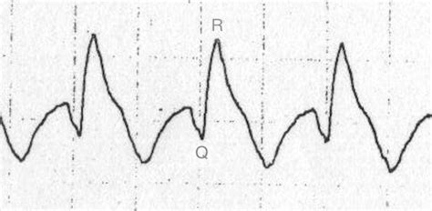 Vt Versus Svt Ekg Interpretation Basic Ekg