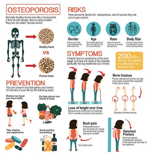 Osteoporosis Illustrations Royalty Free Vector Graphics And Clip Art