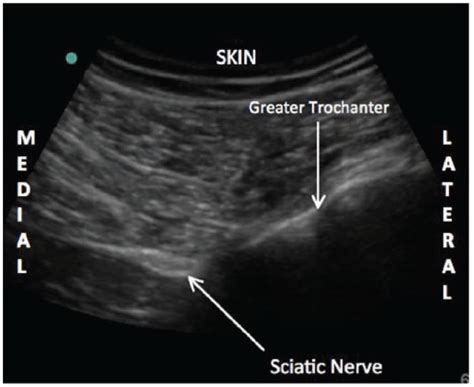 Ultrasound Image Of The Infragluteal Sciatic Nerve Notice The Download Scientific Diagram