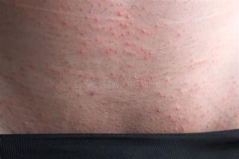 Rash On The Skin Of A Man In The Groin Area The Concept Of Venereal