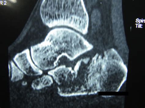 Case 1 Pre Op Ct Scan Calcaneum Sagittal Plane Download