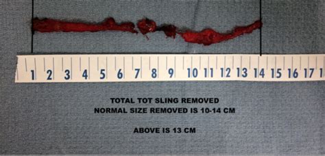 Pelvic Mesh Complications Miklos And Moore Urogynecology