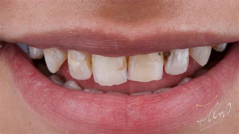 Direct Anterior Restorations Layering Technique MyZerodonto