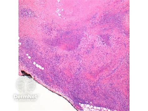Granuloma Annulare Pathology