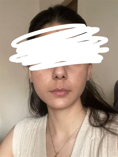 Thiamidol R Melasmaskincare