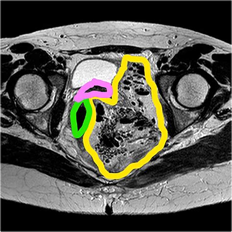Difficult Supralevator Abscess Draining Through The ‘posterior