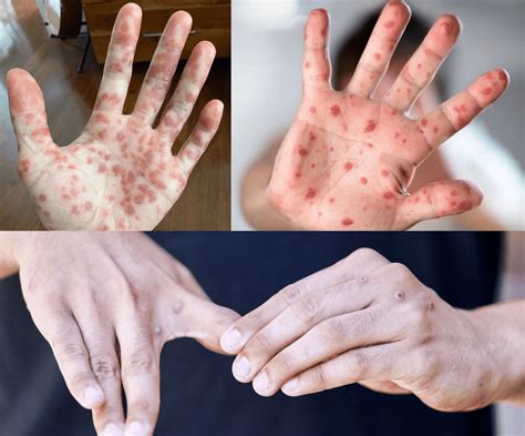 Bệnh đậu mùa khỉ có nguy hiểm không