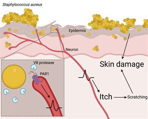 Effect Of Staphylococcus Aureus Colonization And Immune Defects On The Pathogenesis Of Atopic