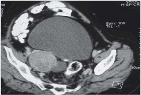 Cect Abdomen Showing Solid Cystic Lesion In Right Adnexa Measuring 52